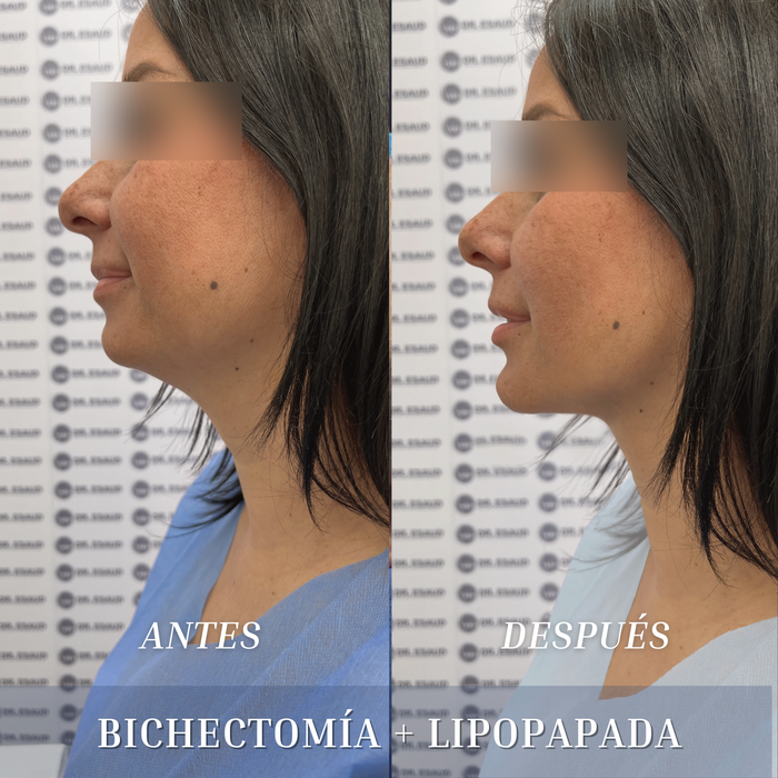 Lipopapada + Bichectomía - Dr. Esaud